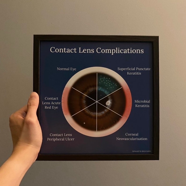 Optometry Wall Art - Contact Lens Complications - Etsy