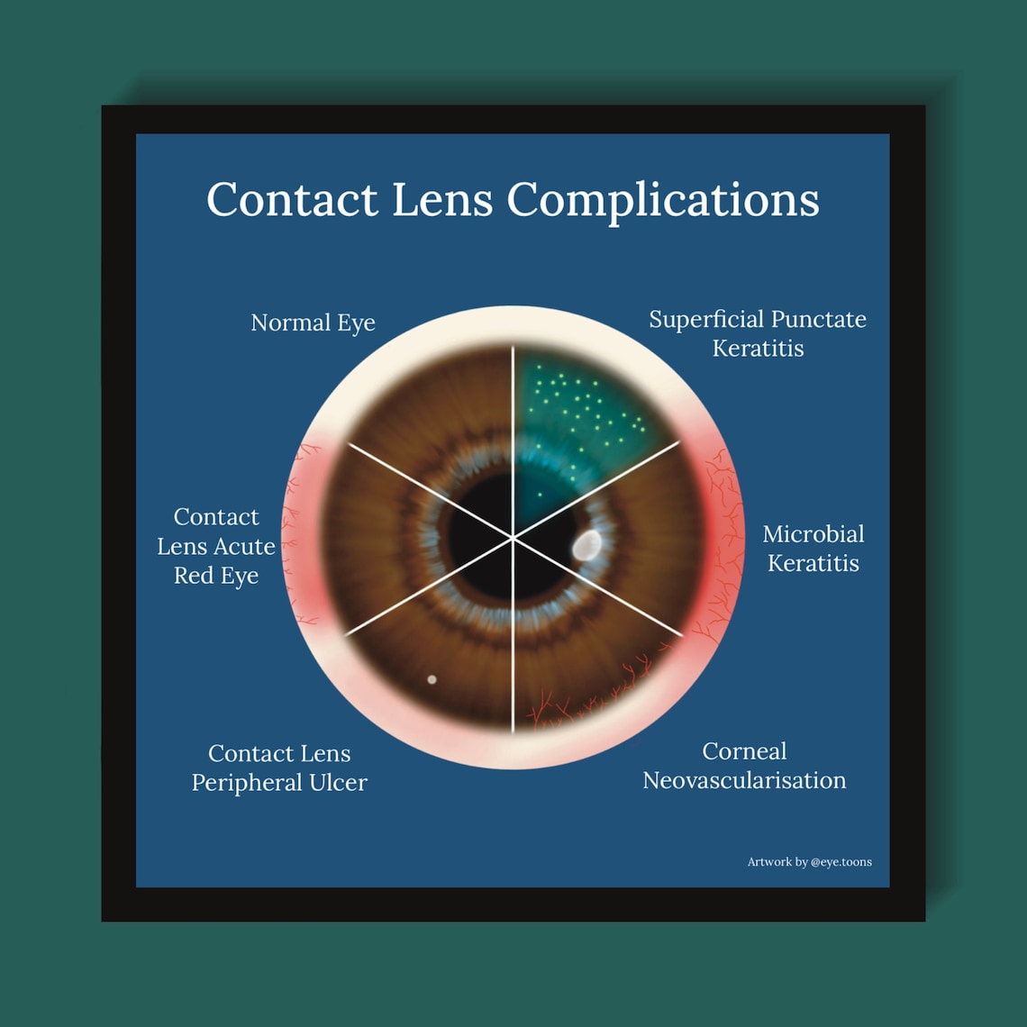 Optometry Wall Art - Contact Lens Complications - Etsy