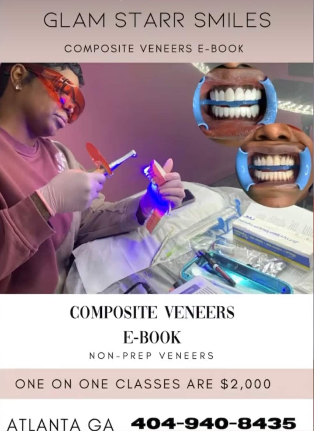 Composite Veneers Step by Step Video & E-book Plus Full Supplies List ...