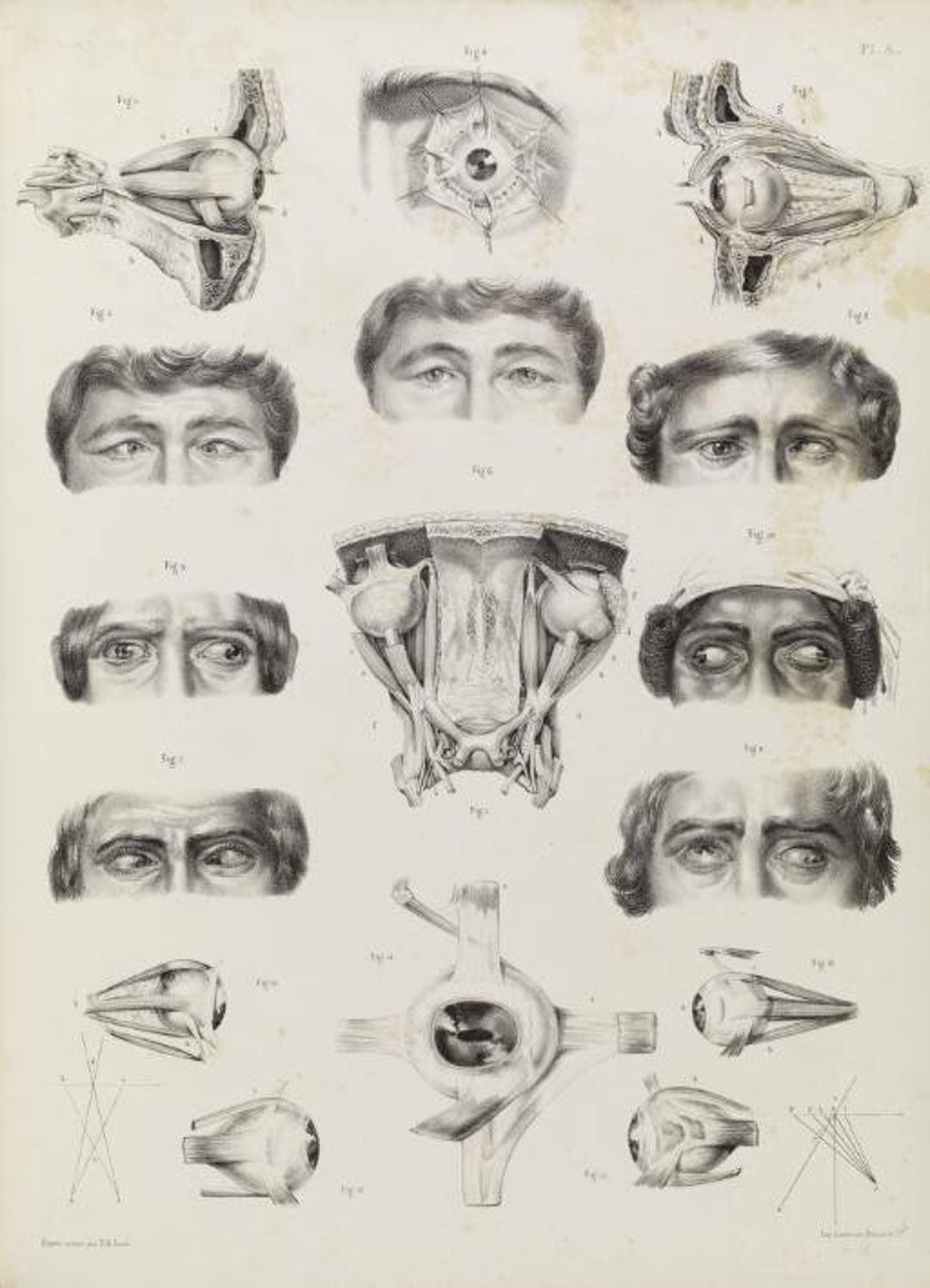 Vintage Illustration of Strabismus a Condition When the Eyes - Etsy