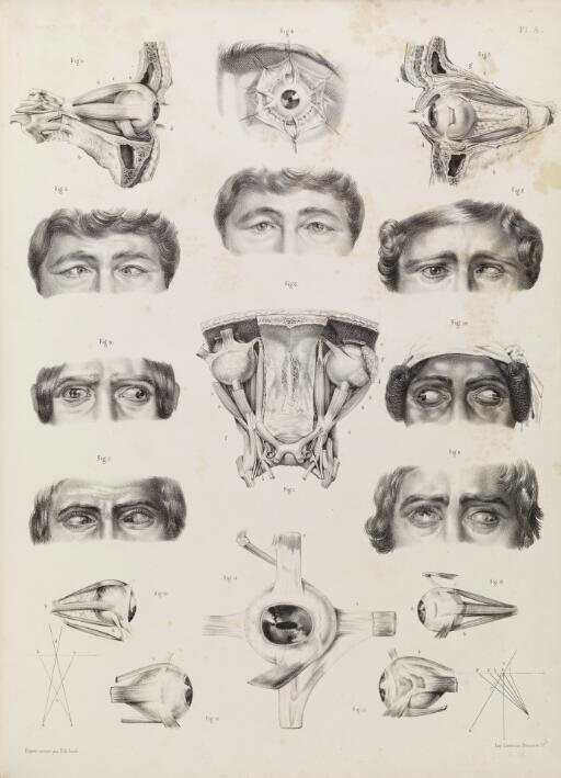 Vintage Illustration of Strabismus a Condition When the Eyes - Etsy