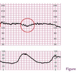 An Acronym to Remember the Types and Causes of Fetal Heart Rate ...