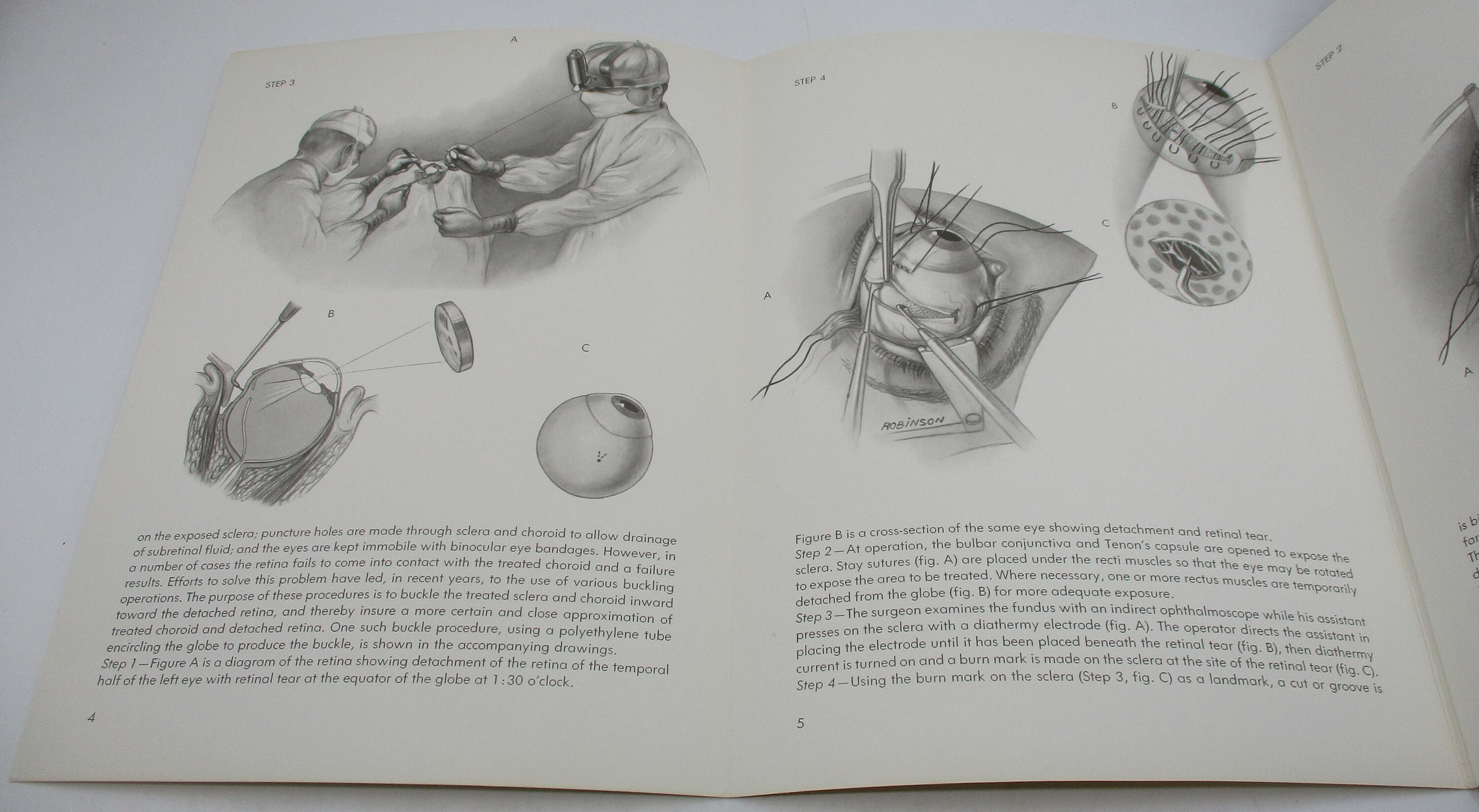 Undated Eye Surgery Pamphlet, Buckling Operation for Retinal Attachment ...