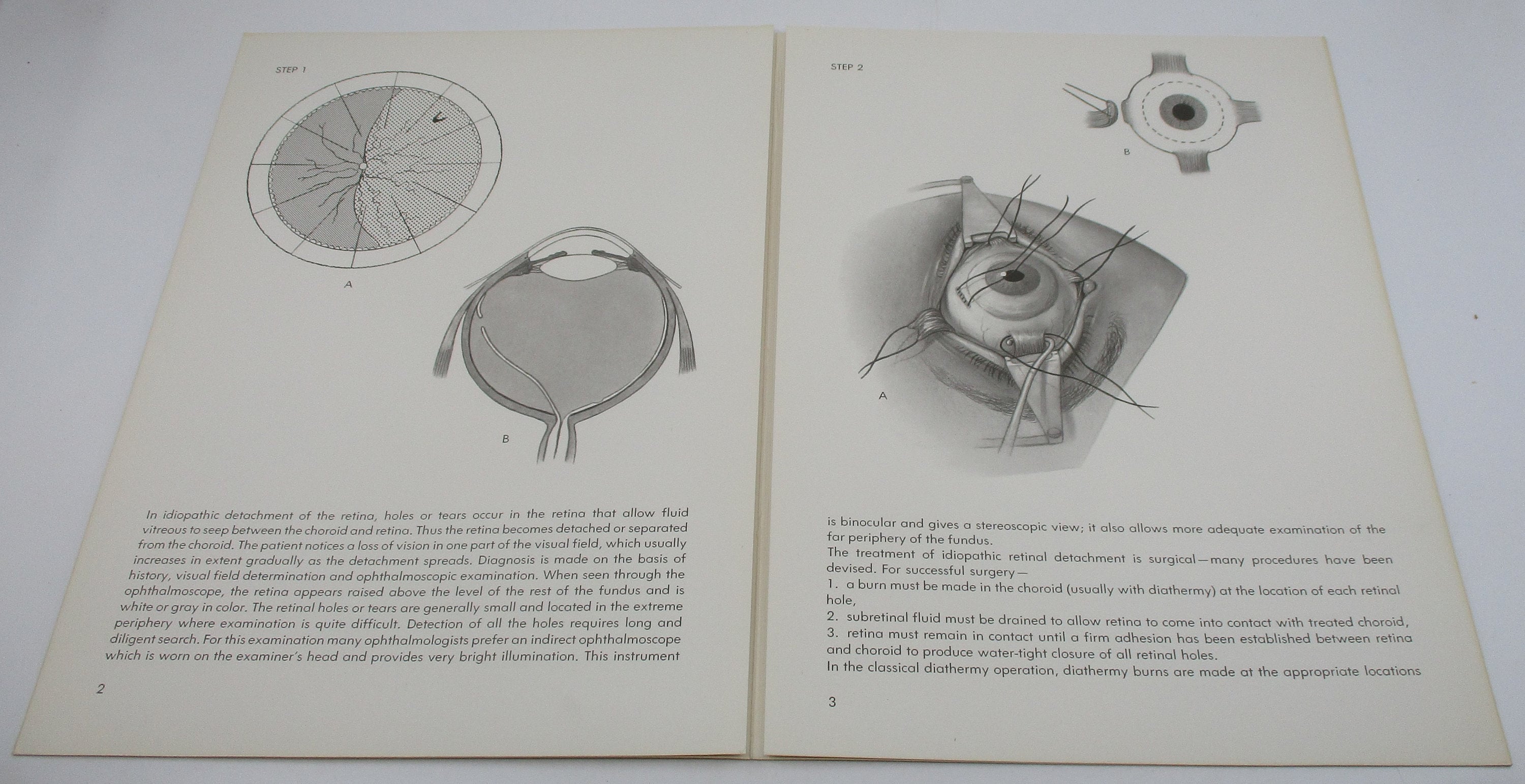 Undated Eye Surgery Pamphlet, Buckling Operation for Retinal Attachment ...