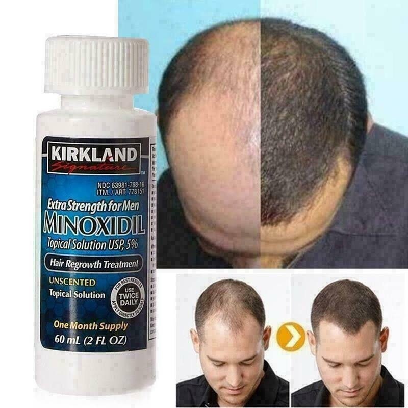 Kirkland 5% Minoxidil Hair Growth Solution - Etsy Australia