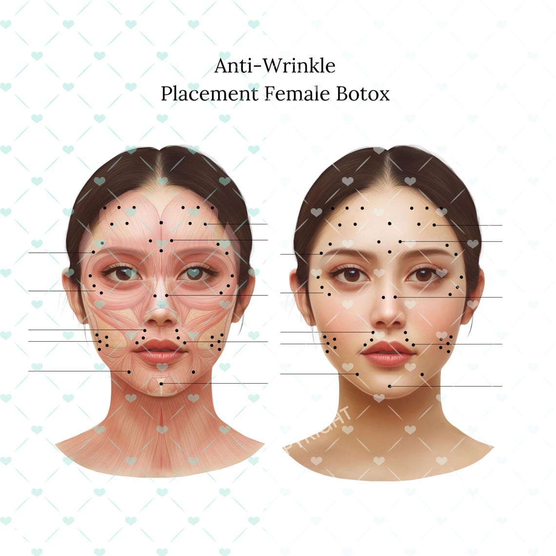 Botox Injection Points on Muscle Anatomy PNG| Botox & Filler Injector ...