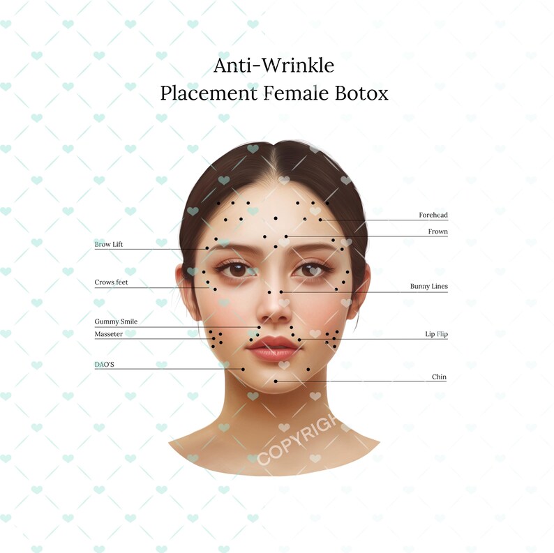 Botox Injection Points on Muscle Anatomy PNG| Botox & Filler Injector ...