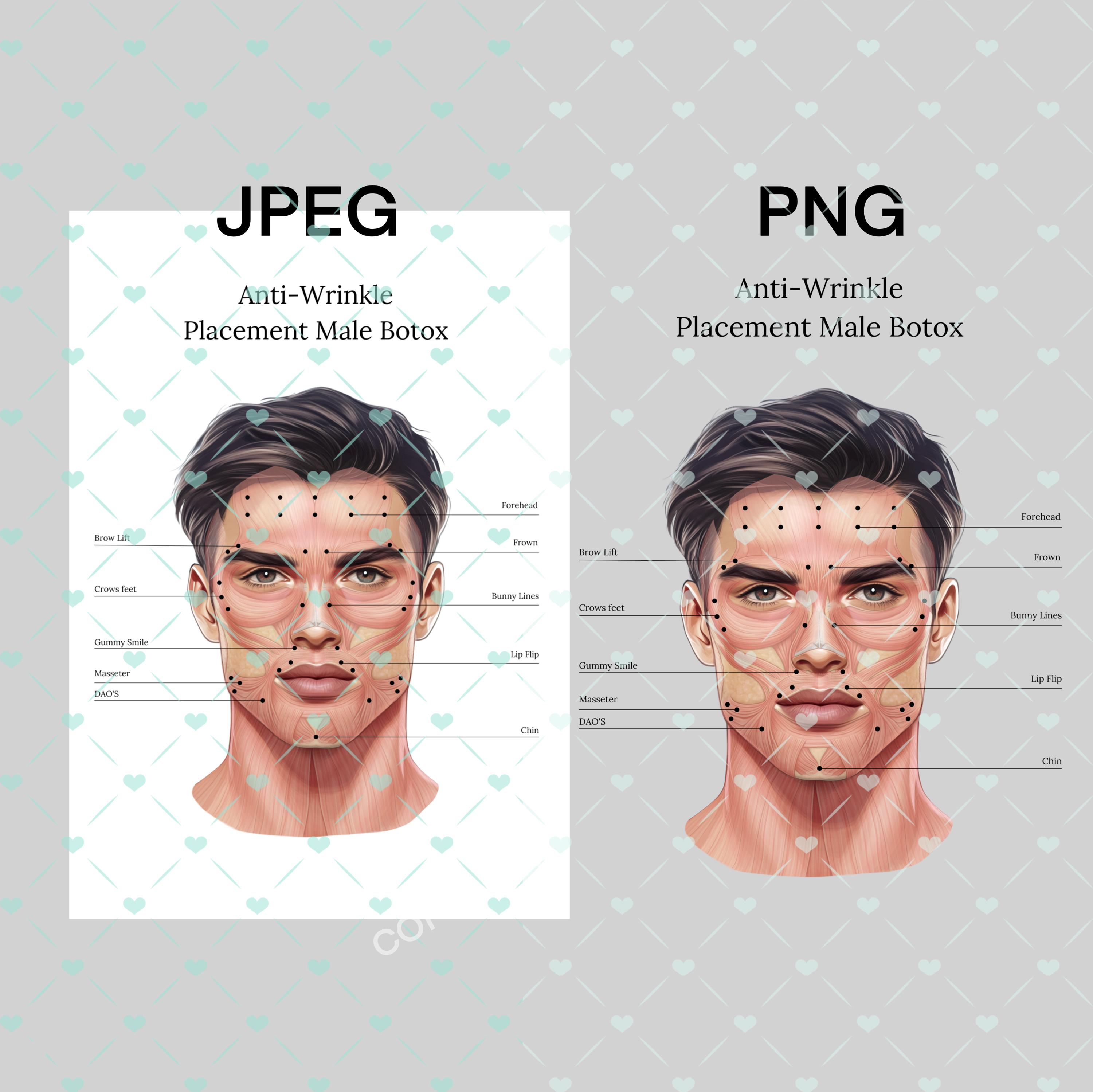 Male BOTOX Injection Points Bundle | Botox & Filler Injector | Anatomy ...