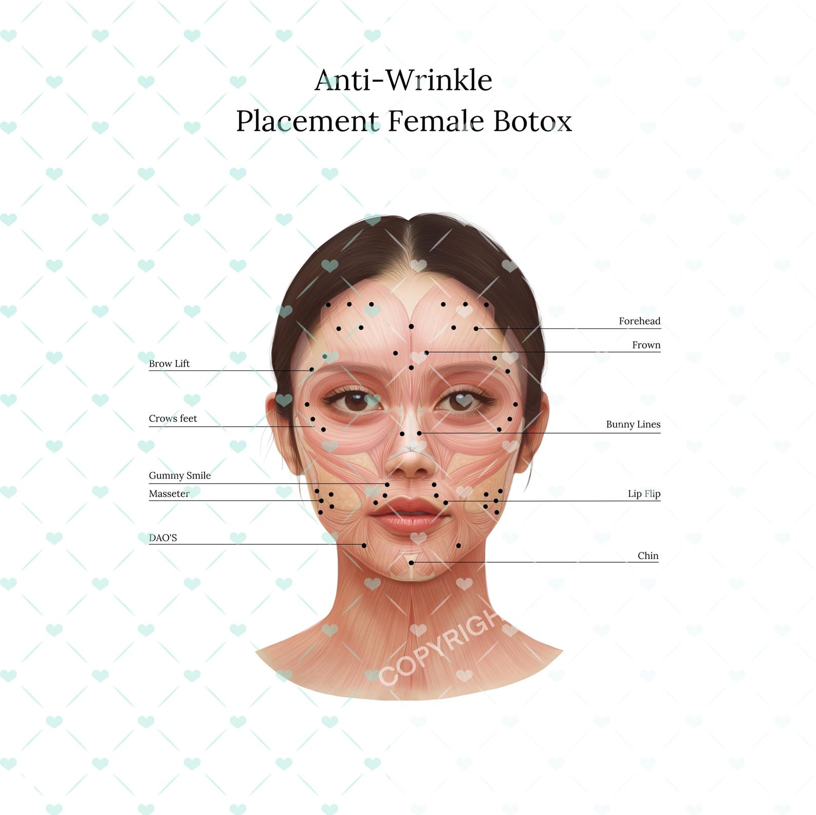 Botox Injection Points on Muscle Anatomy PNG| Botox & Filler Injector ...