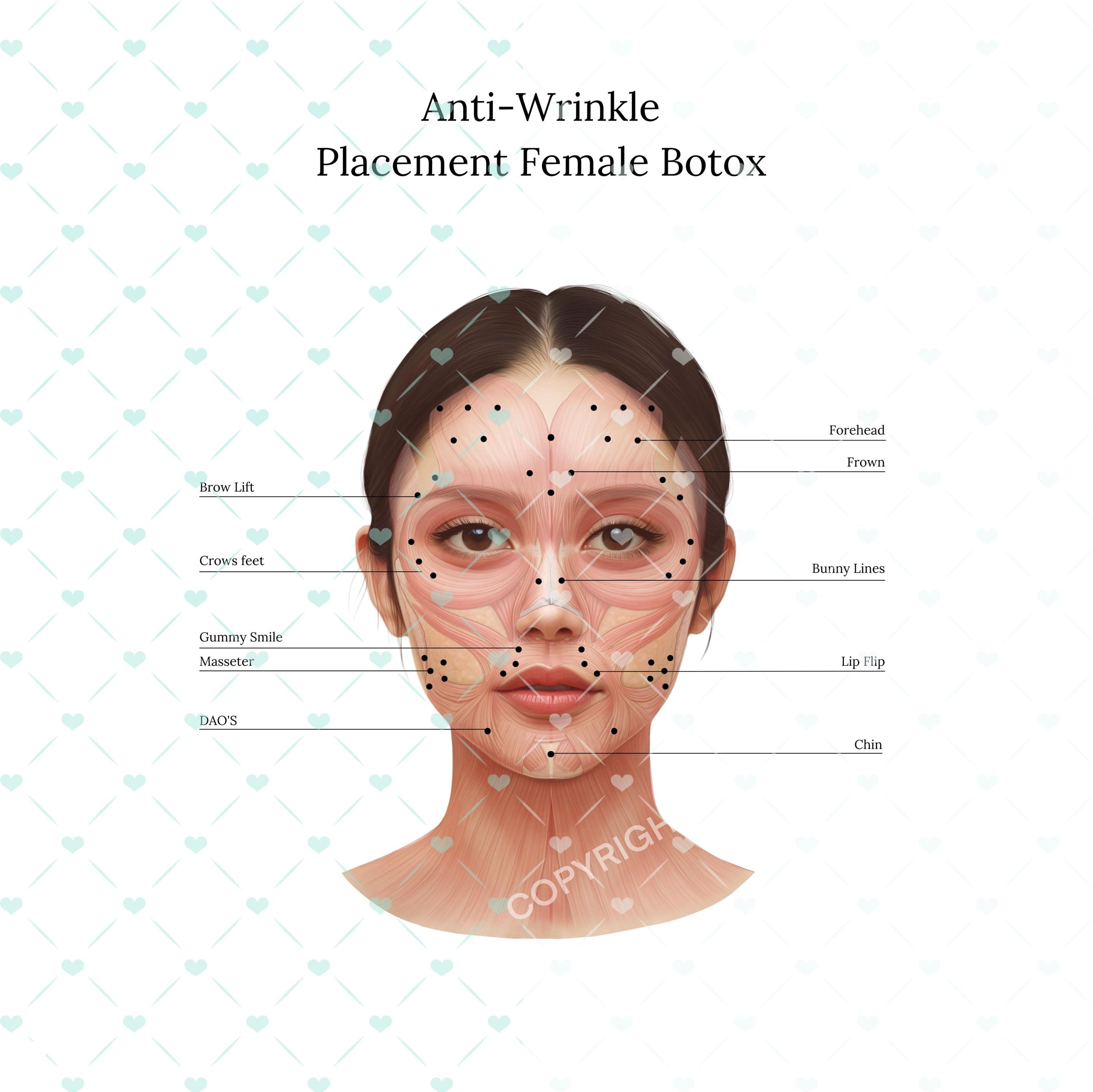 Botox Injection Points on Muscle Anatomy PNG| Botox & Filler Injector ...