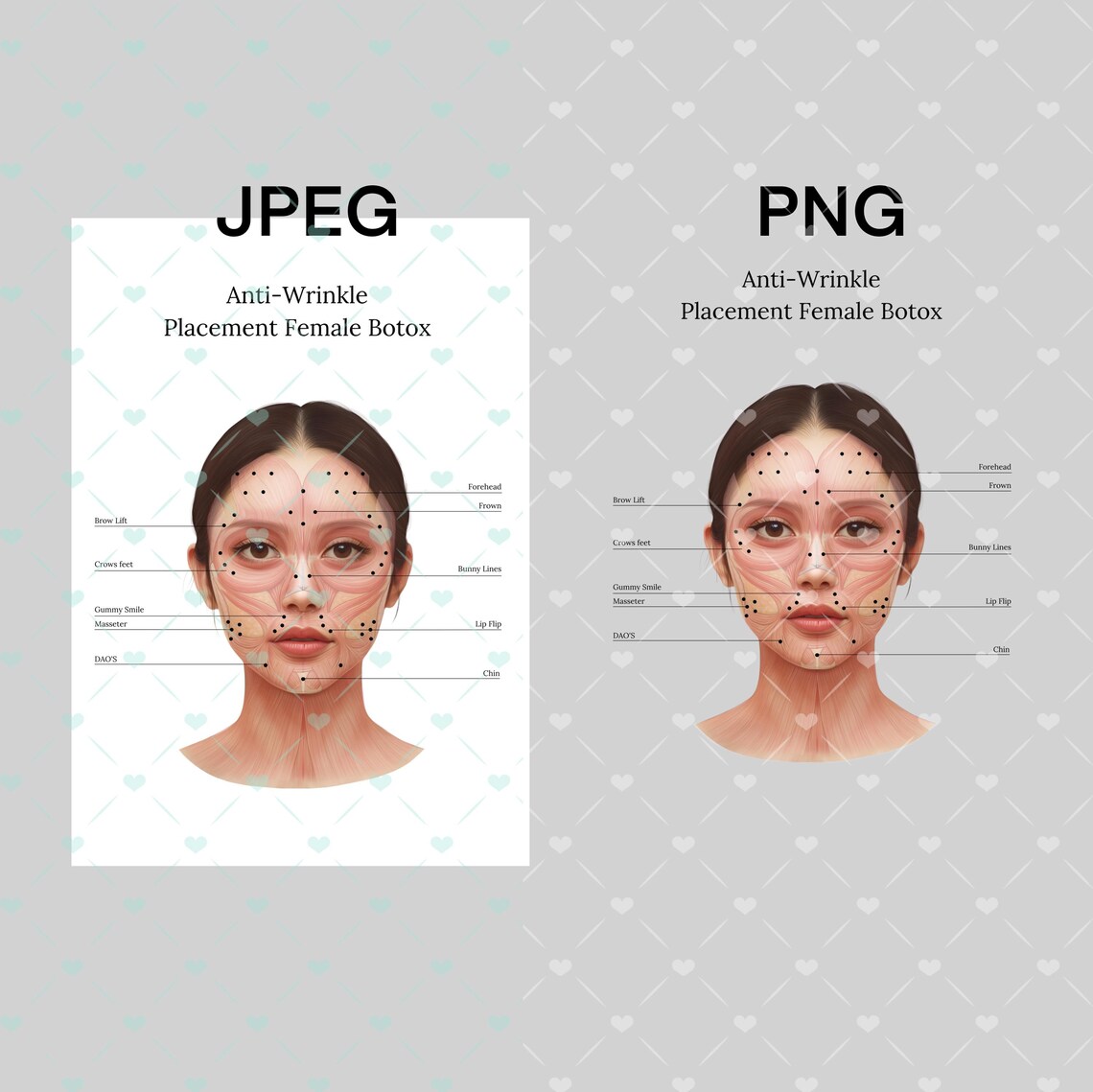 Botox Injection Points on Muscle Anatomy PNG| Botox & Filler Injector ...