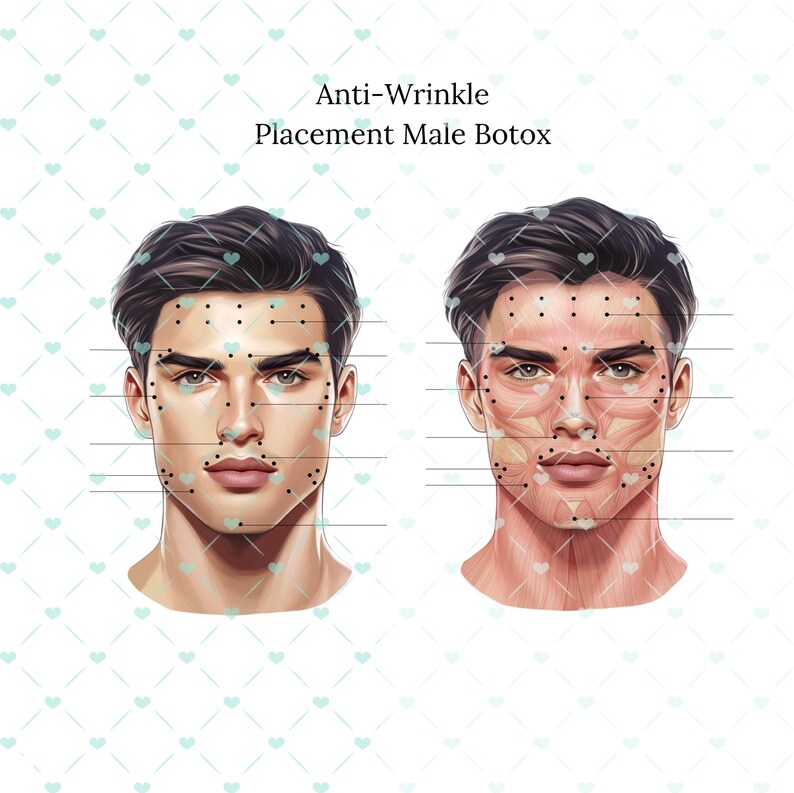Male BOTOX Injection Points Bundle | Botox & Filler Injector | Anatomy ...