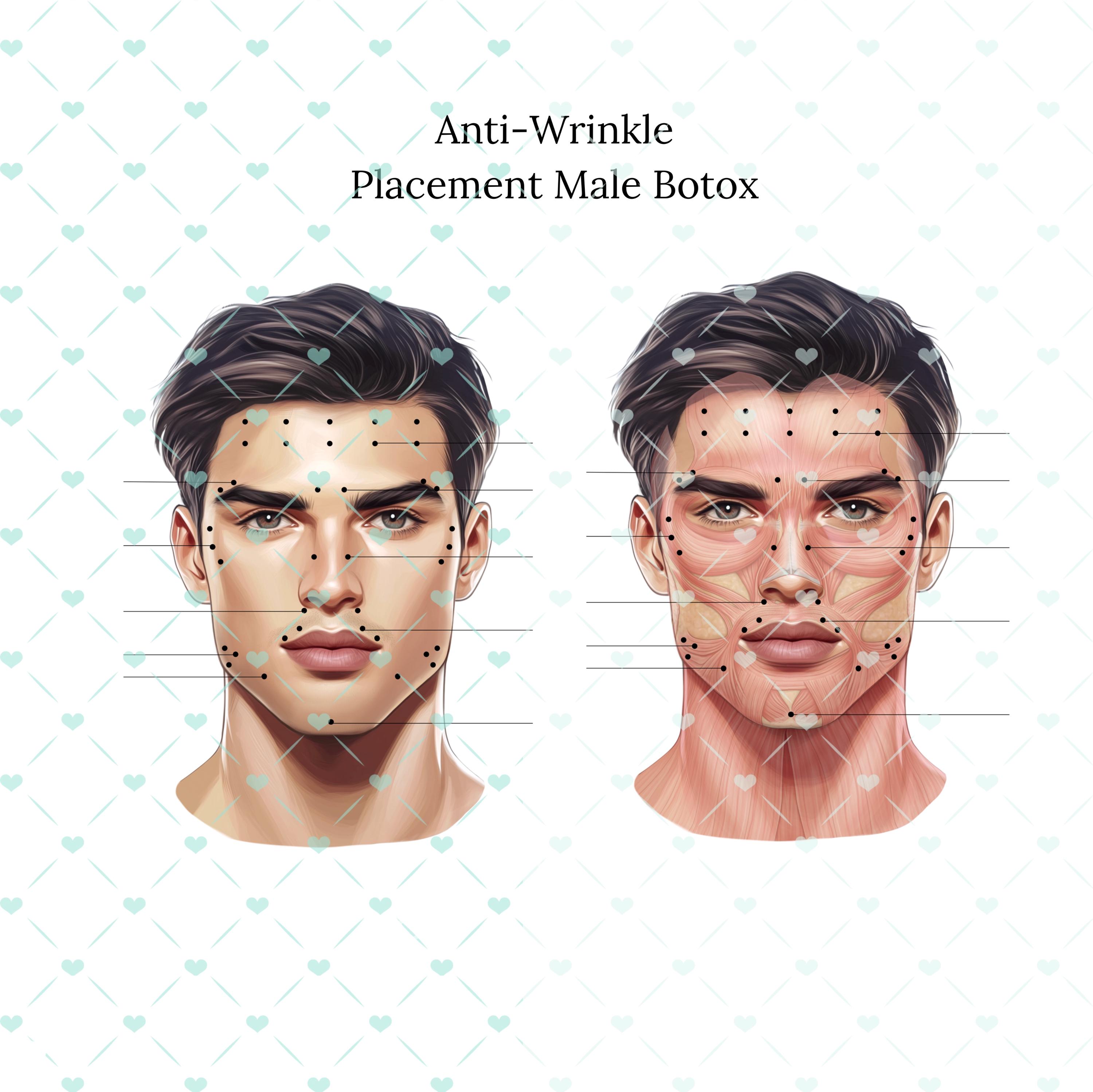 Male BOTOX Injection Points Bundle | Botox & Filler Injector | Anatomy ...