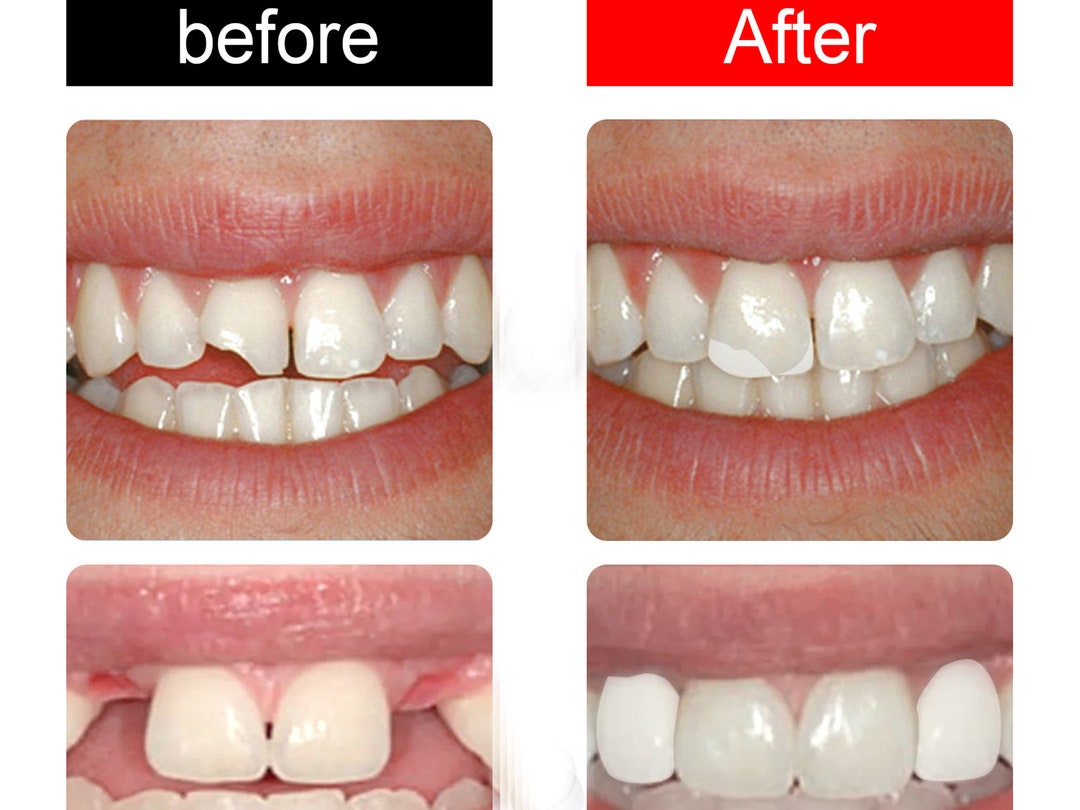 Moldable Dentures Dental Gel Set Party Makeup Temporary - Etsy