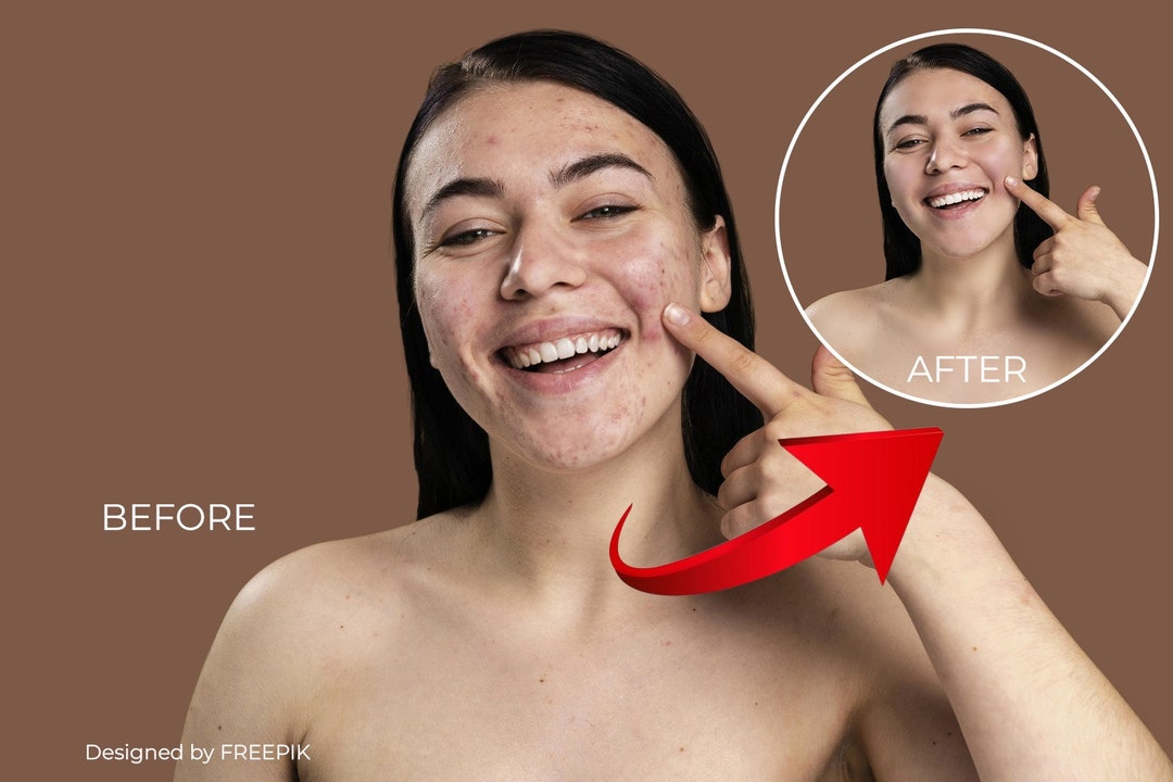 Acne Removal, Photo Retouching, Spots Removal, Face Beautifier - Etsy