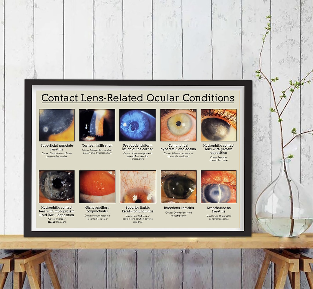 Disturbing Eye Poster Contact Lens Anatomy Pull Down Chart Physiology ...