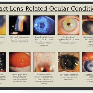 Disturbing Eye Poster Contact Lens Anatomy Pull Down Chart Physiology ...