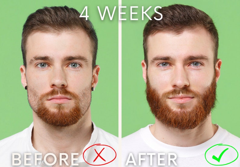 Accelerate Hair Growth - 3 Month Supply - Visible Results - Etsy