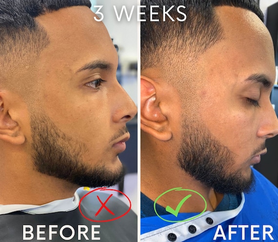 Patchy Beard Progress