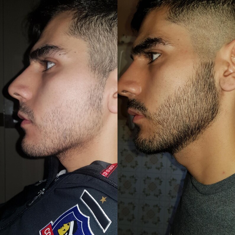 Accelerate Hair Growth - 3 Month Supply - Visible Results - Etsy