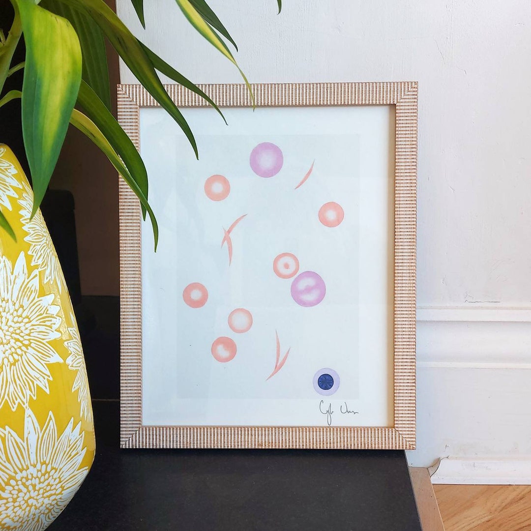 Sickle Cell Anaemia Art Giclée Print, Haematology Cell Art, Biomedical ...