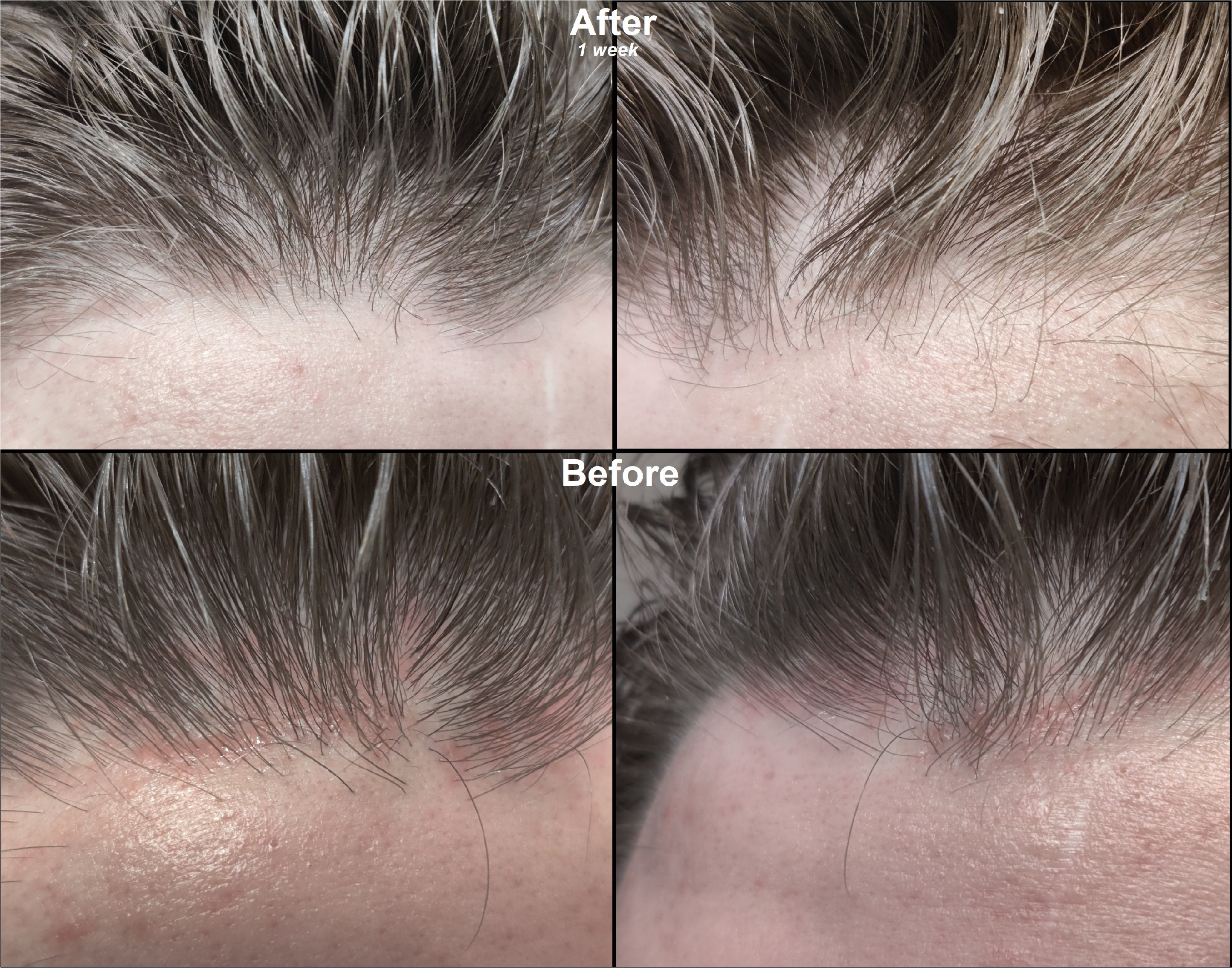 Lemon Drop - Anti-dandruff Beard & Scalp Oil | Treatment for Dandruff ...