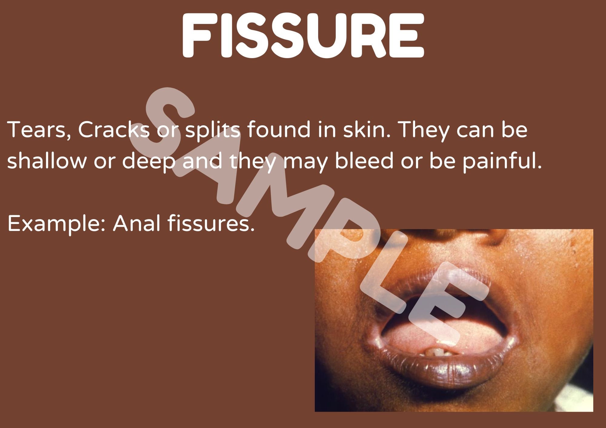 Dermatology Flashcards - Skin Lesions Below the Skin - Etsy