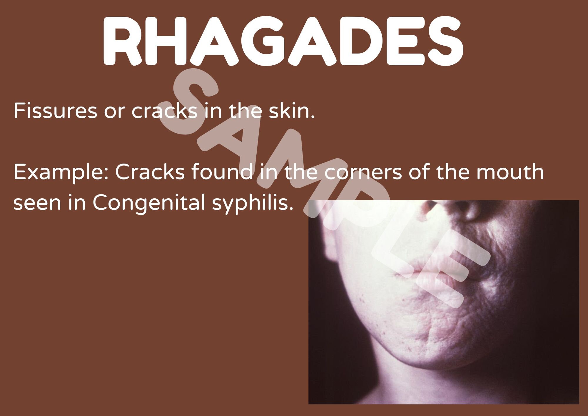 Dermatology Flashcards - Skin Lesions Below the Skin - Etsy