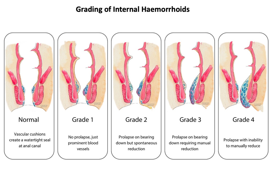 Grading of Internal Haemorrhoids- Digital Download - Etsy