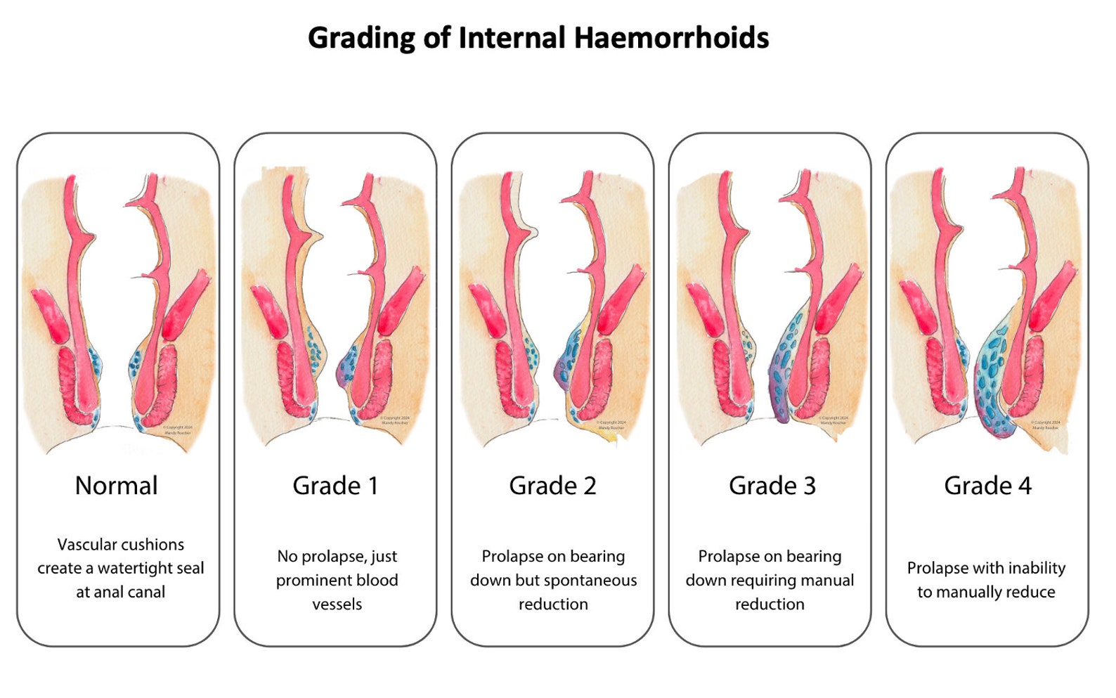 Grading of Internal Haemorrhoids- Digital Download - Etsy