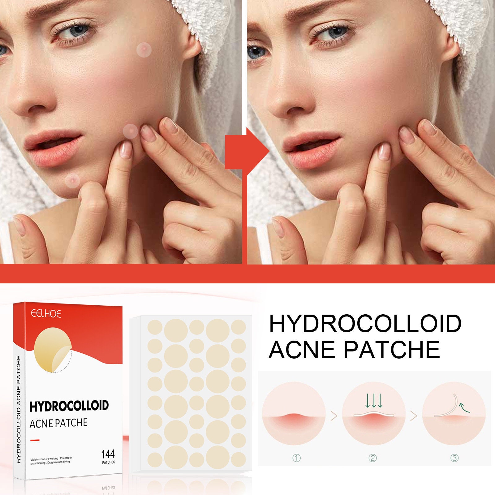 Hydrocolloid Acne