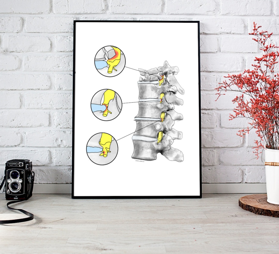 Vertebral Pathologies - Anatomy - Art - Without Frame - Etsy
