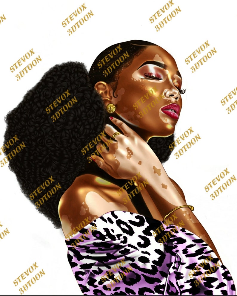 Vitiligo Queen Melanin Goddess Skin Pigmentation Beautiful Soul Vibes ...