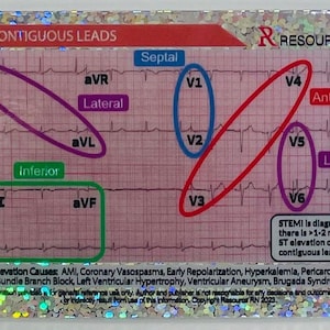 Glitter Sticker - EKG STEMI Reference Tool RN Card - Etsy