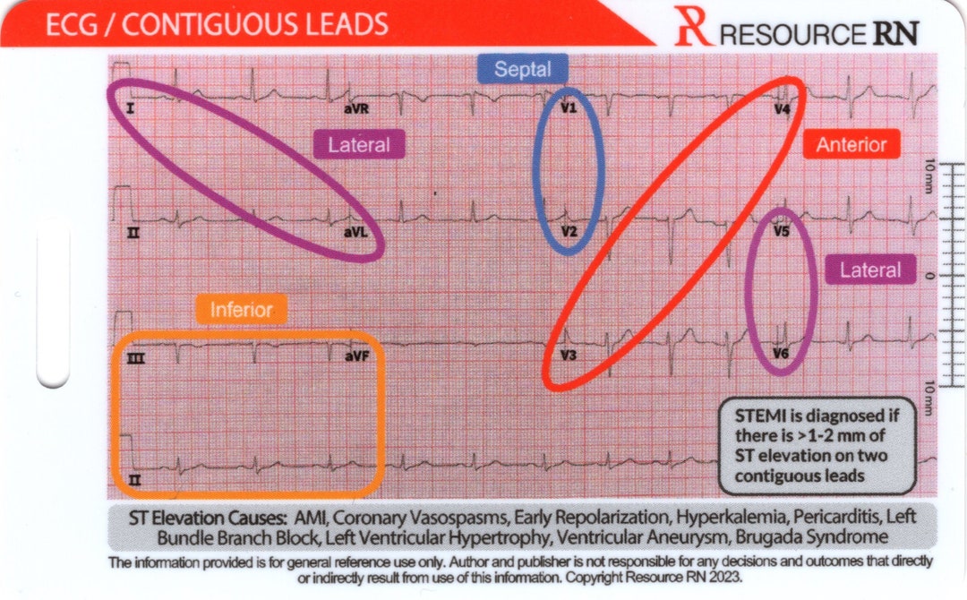 EKG STEMI Reference Tool Badge Card Pocket Guide - Etsy