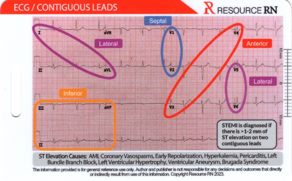 EKG STEMI Reference Tool Badge Card Pocket Guide - Etsy