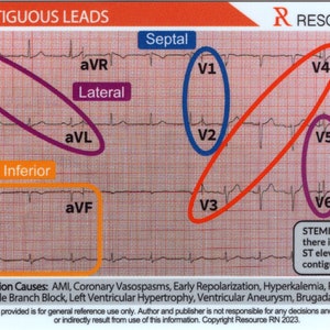 EKG STEMI Reference Tool VERTICAL Badge Card Pocket Guide - Etsy