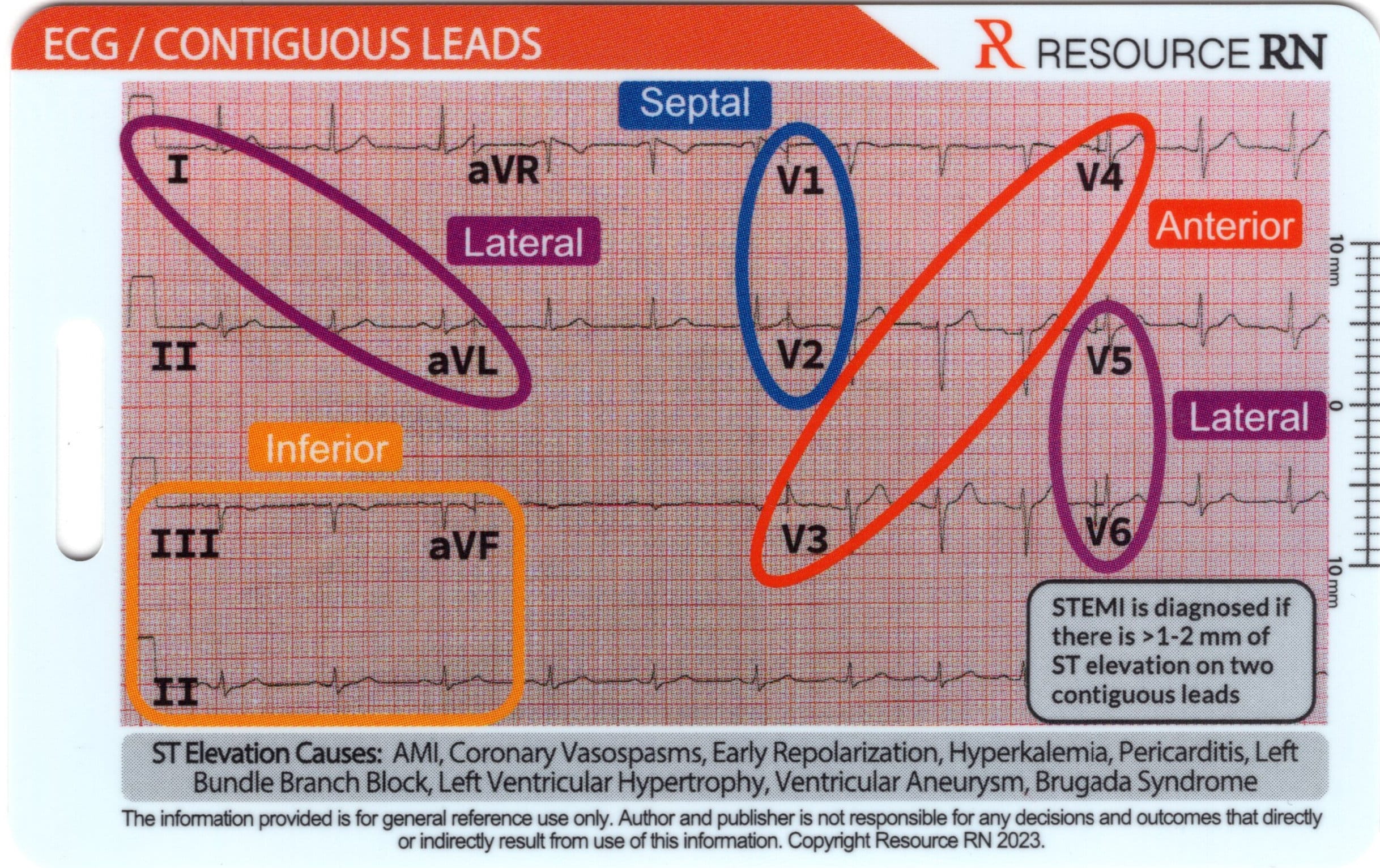 EKG STEMI Reference Tool VERTICAL Badge Card Pocket Guide - Etsy UK