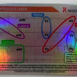 Holographic Sticker - EKG STEMI Reference Tool Badge Card - Etsy