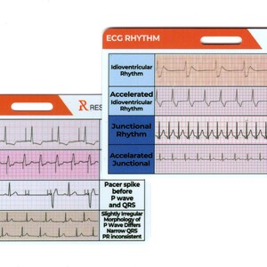 EKG Rhythm, STEMI, NSTEMI Analysis Reference Cards—6-card Set for Rapid ...