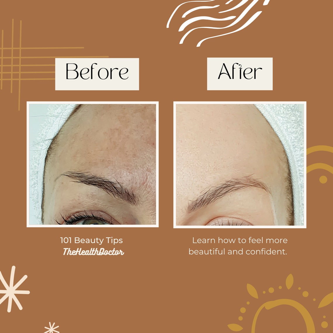 How to Get Rid of Acne, 101 Beauty Tips, Digital Ebook/ Instant ...