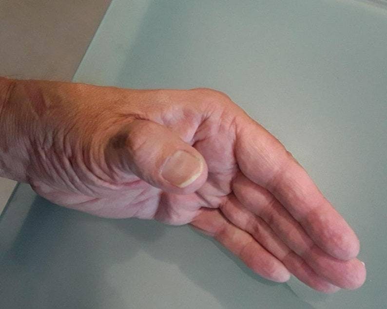 Arthritis Finger MCP Joints Splint Brass or Sterling Silver - Etsy