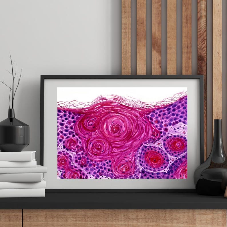 Squamous Cell Carcinoma, Skin Cancer, Pathology Print - Etsy