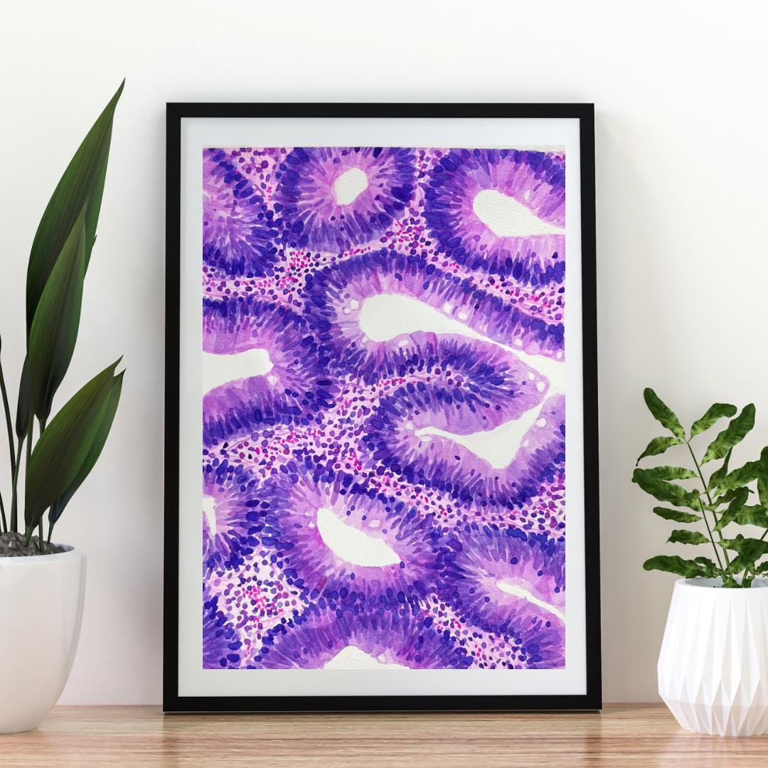 Colon Adenoma, Pathology Art Original Painting, Watercolor, 9x12" - Etsy