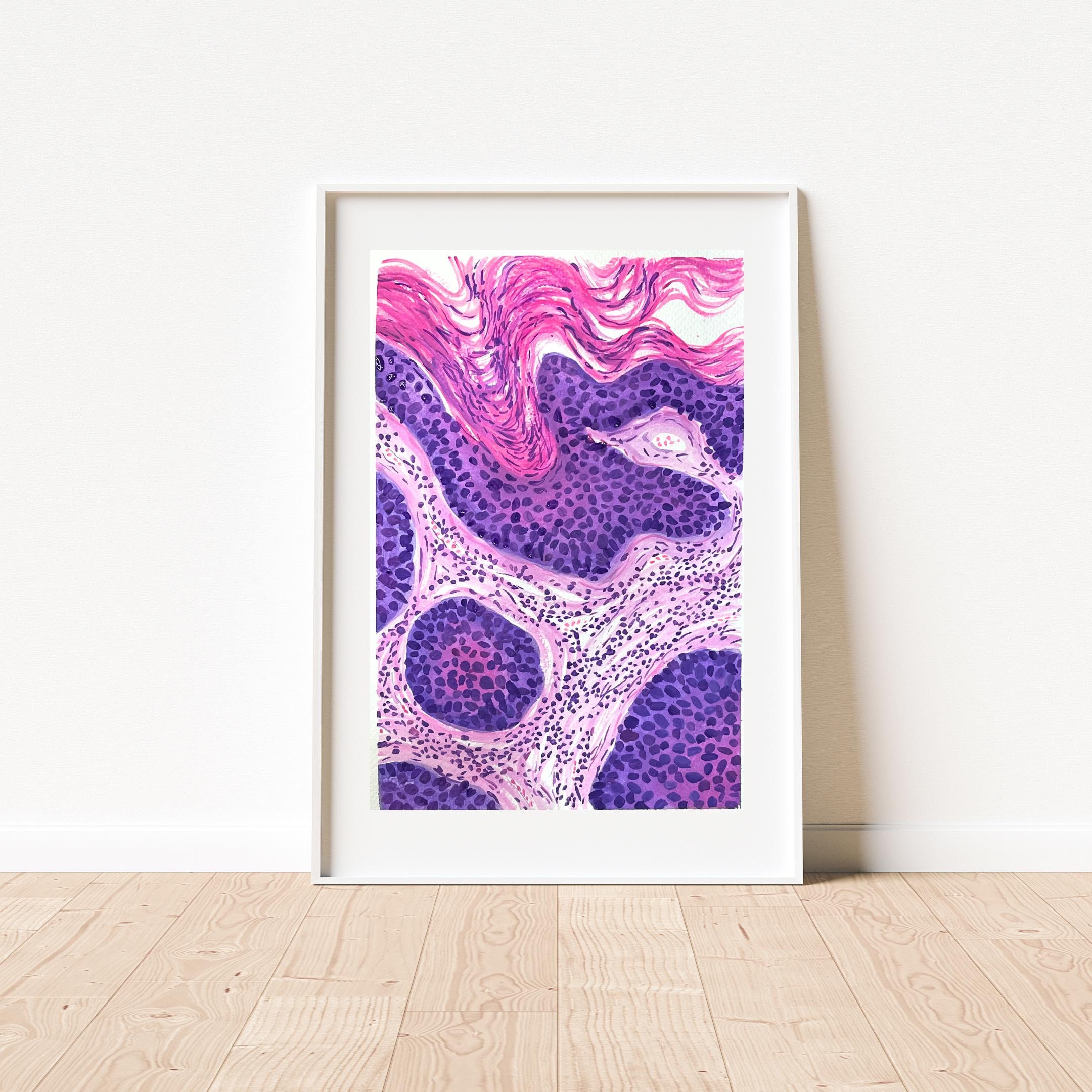 Squamous Cell Carcinoma II, Original Gouache Pathology Painting, 7x10 ...