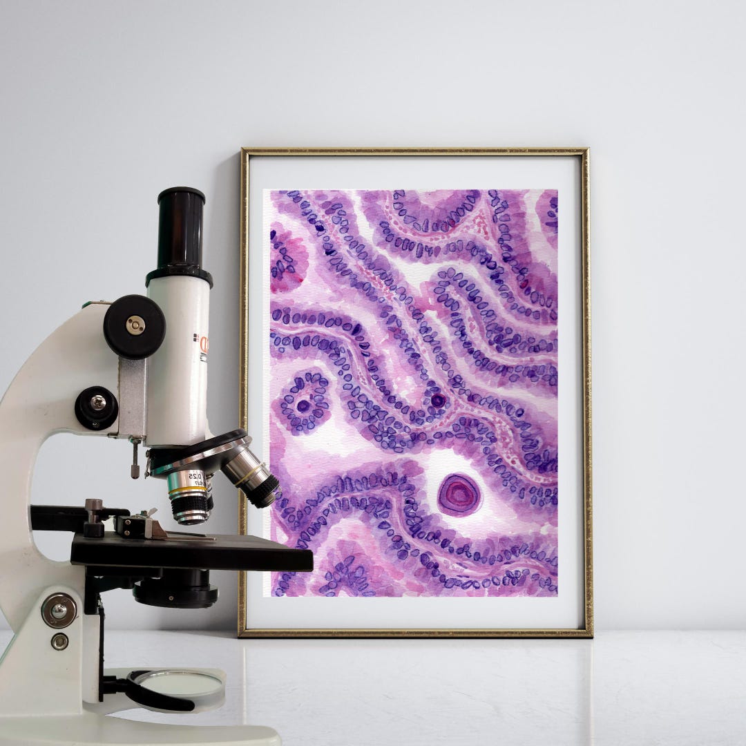 Papillary Thyroid Carcinoma, Pathology Art, 9x12" Watercolor - Etsy