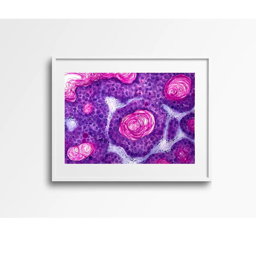 Squamous Cell Carcinoma Histology, Pathology Art Original Painting ...