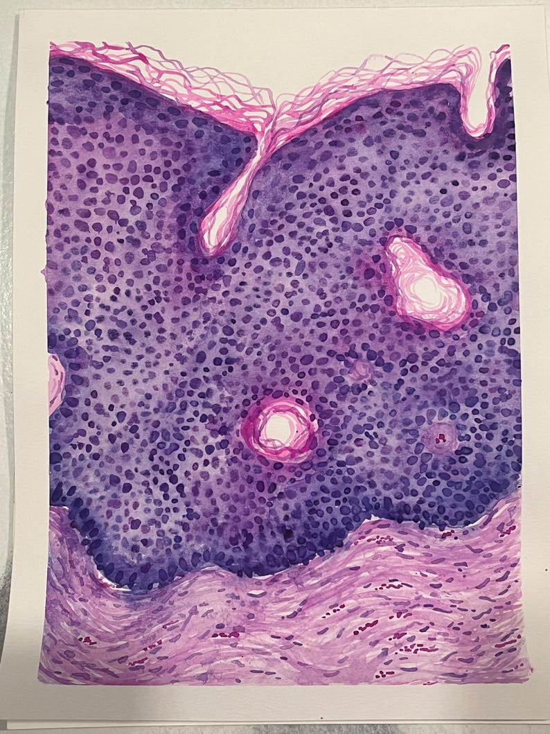 Skin Histology, Seborrheic Keratosis, Pathology Art Original Painting ...