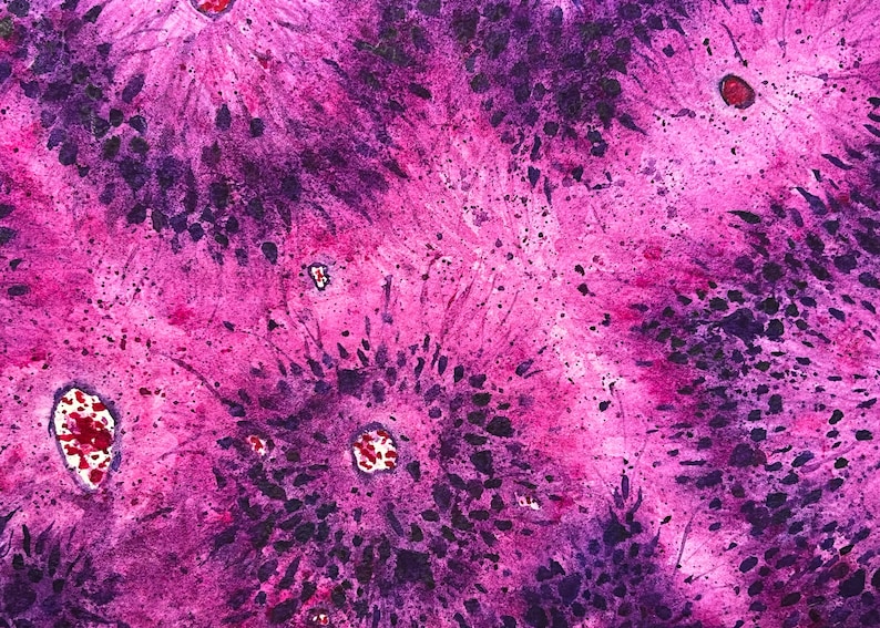 Pathology Art Print: Abstract, Brain Cancer - Etsy