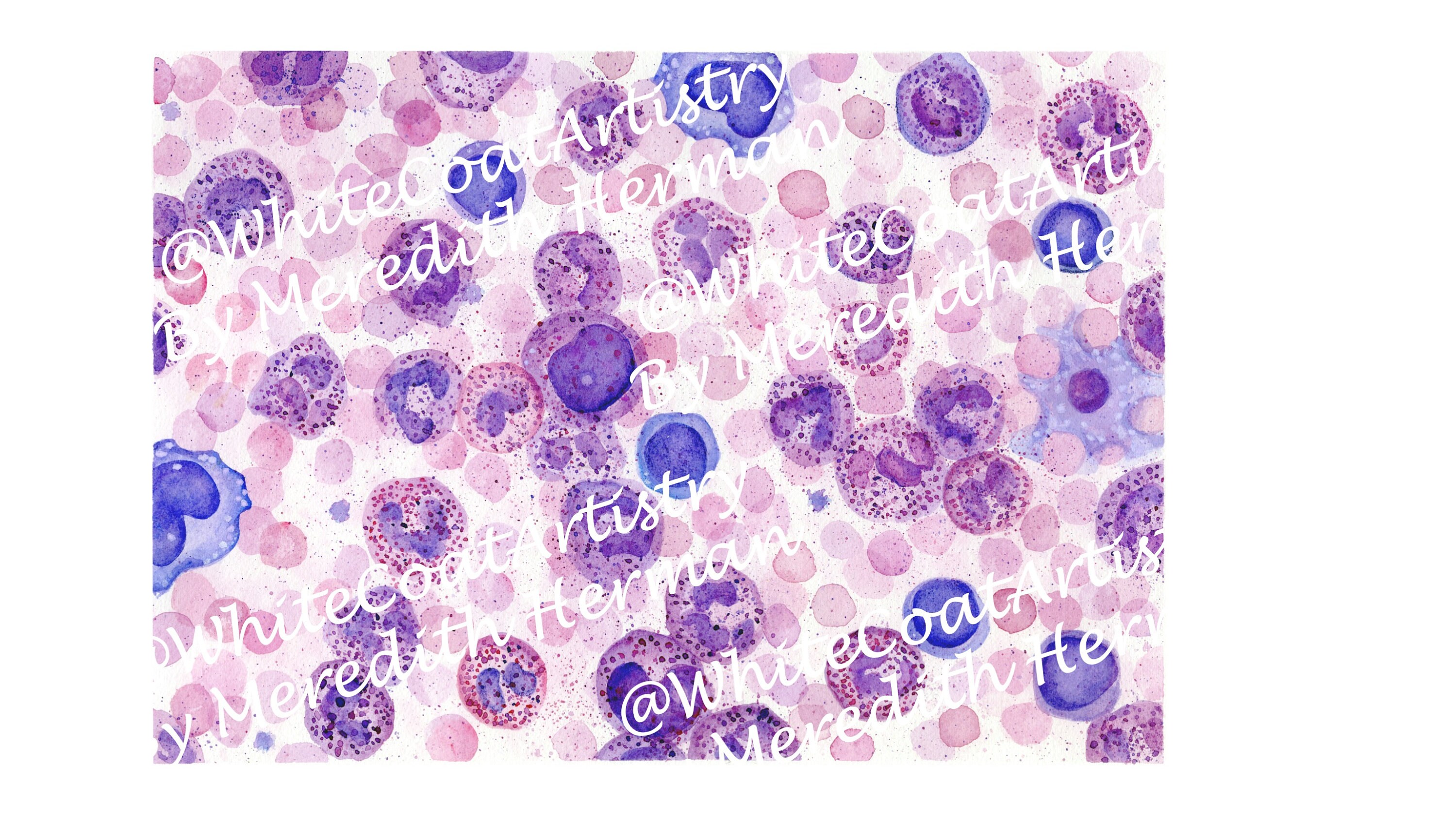 Chronic Myeloid Leukemia, Pathology Art Print - Etsy
